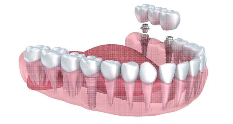 Dental Implants | Denver Dentist | Dental Implants | (303) 756-3289